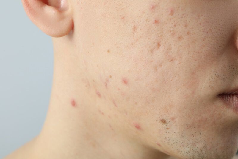 Altersakne bei Männern: Was hilft dagegen? | BIOTHERM HOMME